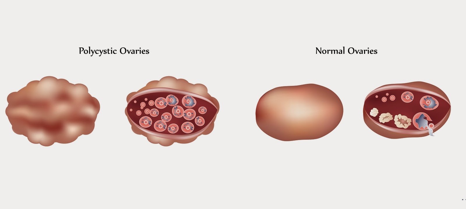 Ini lo 12 Penyebab Terlambat Datang Bulan. Bukan Berarti Lagi Hamil