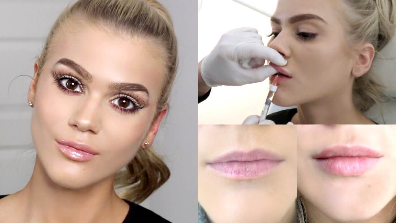 Ratu Kosmetik Hits, Kylie Jenner Resmi Lepas Filler Bibir. Pahami 5 Hal Ini Buat yang Penasaran ...