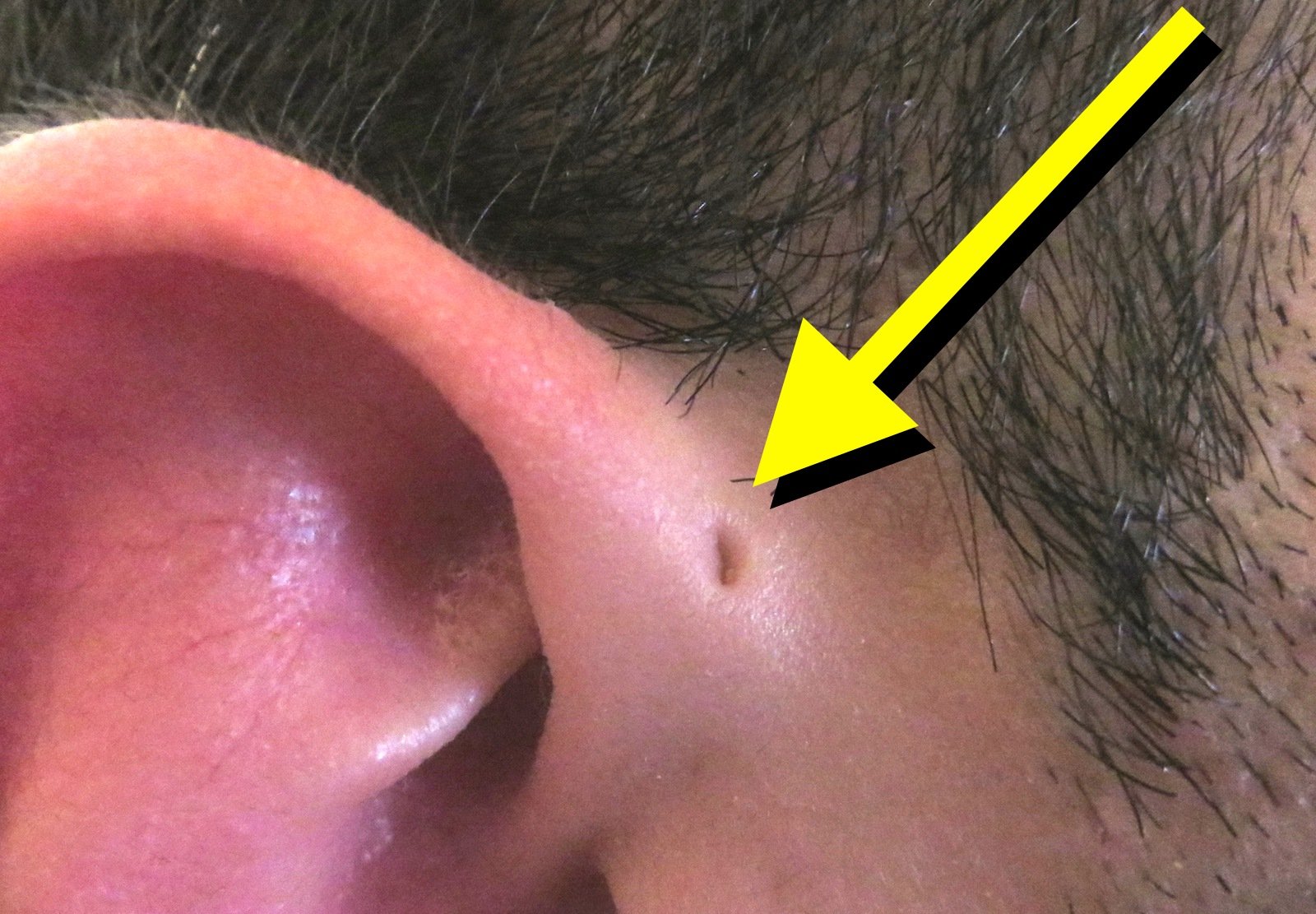 Tentang Infeksi Sinus Preauricular yang Diderita Anak Anji, dan ...