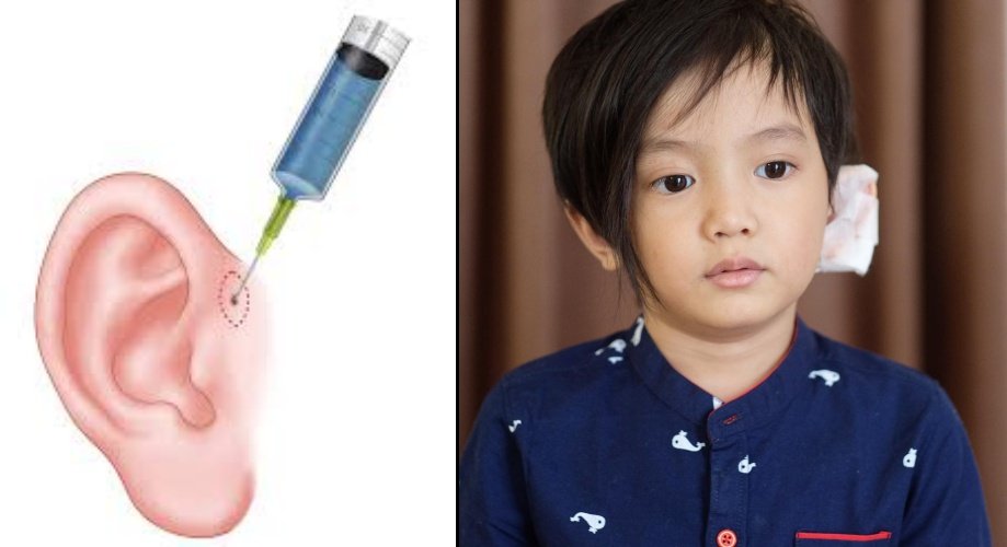 Tentang Infeksi Sinus Preauricular yang Diderita Anak Anji, dan ...