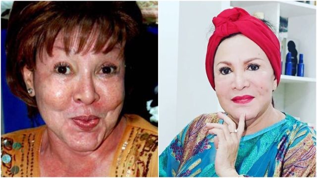 Jalani Operasi Pengangkatan Silikon 21 Kali, Penampilan Mpok Atiek Kini ...