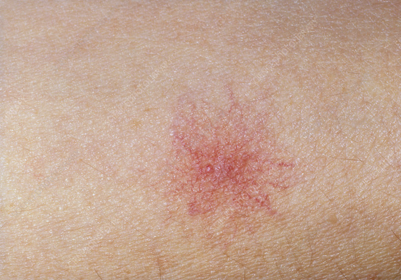 Yuk Kenali 6 Jenis Tanda Lahir yang Umum pada Bayi ini! Hati-hati, Ada ...