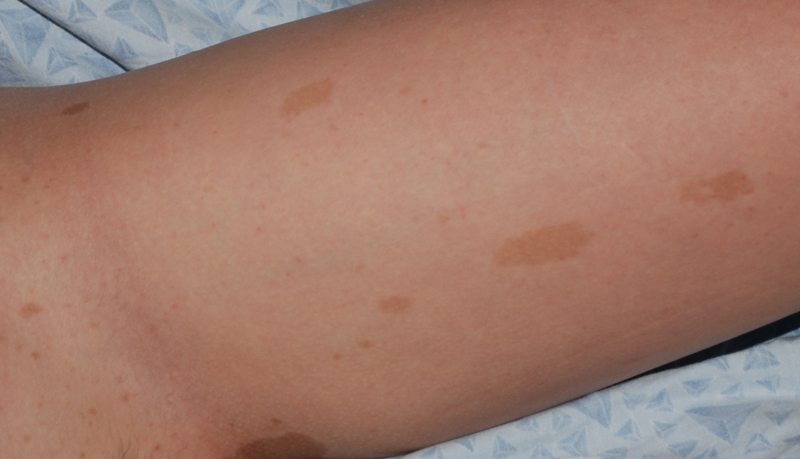 Yuk Kenali 6 Jenis Tanda Lahir yang Umum pada Bayi ini! Hati-hati, Ada ...